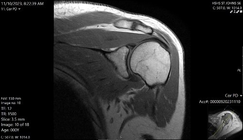 Open Mri At Hshs St Johns Health Center